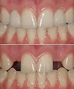 A Question of Missing Teeth | Redwood Shores Orthodontics