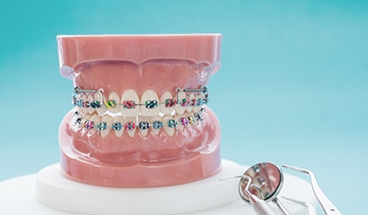 Color Braces - The New Fashion Statement | Redwood Shores Orthodontics